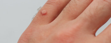 Wat zijn wratten? | Vega Lifestyle Magazine