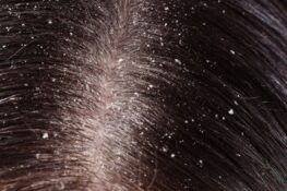 Wat is roos en wat kun je er aan doen? | Vegalifestyle Magazine